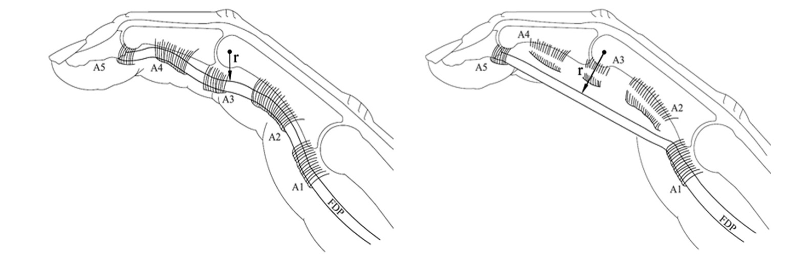 Flexor Tendon Pulley Injuries in Rock Climbers – Sea To Summit Physical ...